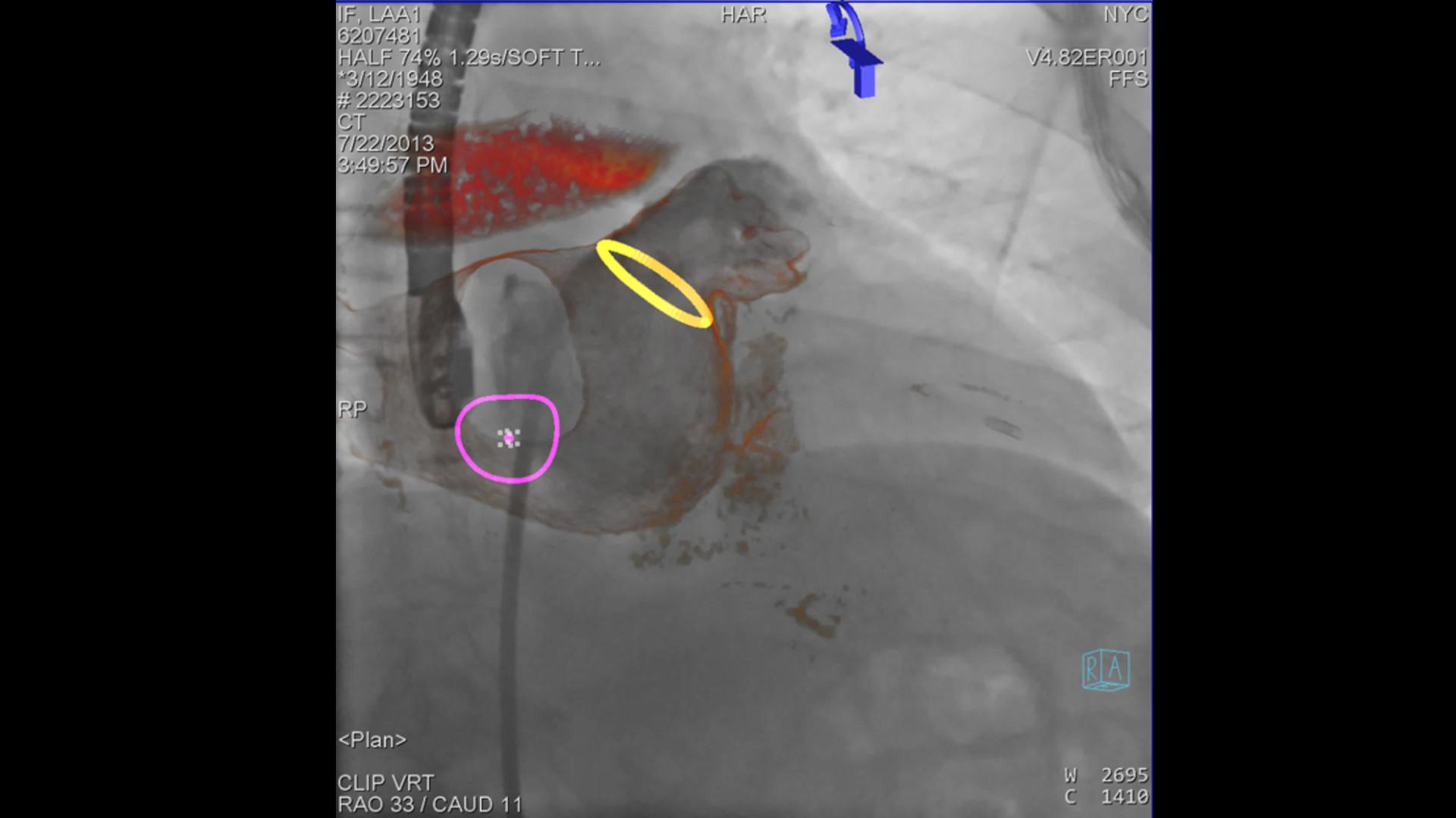 Structural Heart Disease - Siemens Healthineers