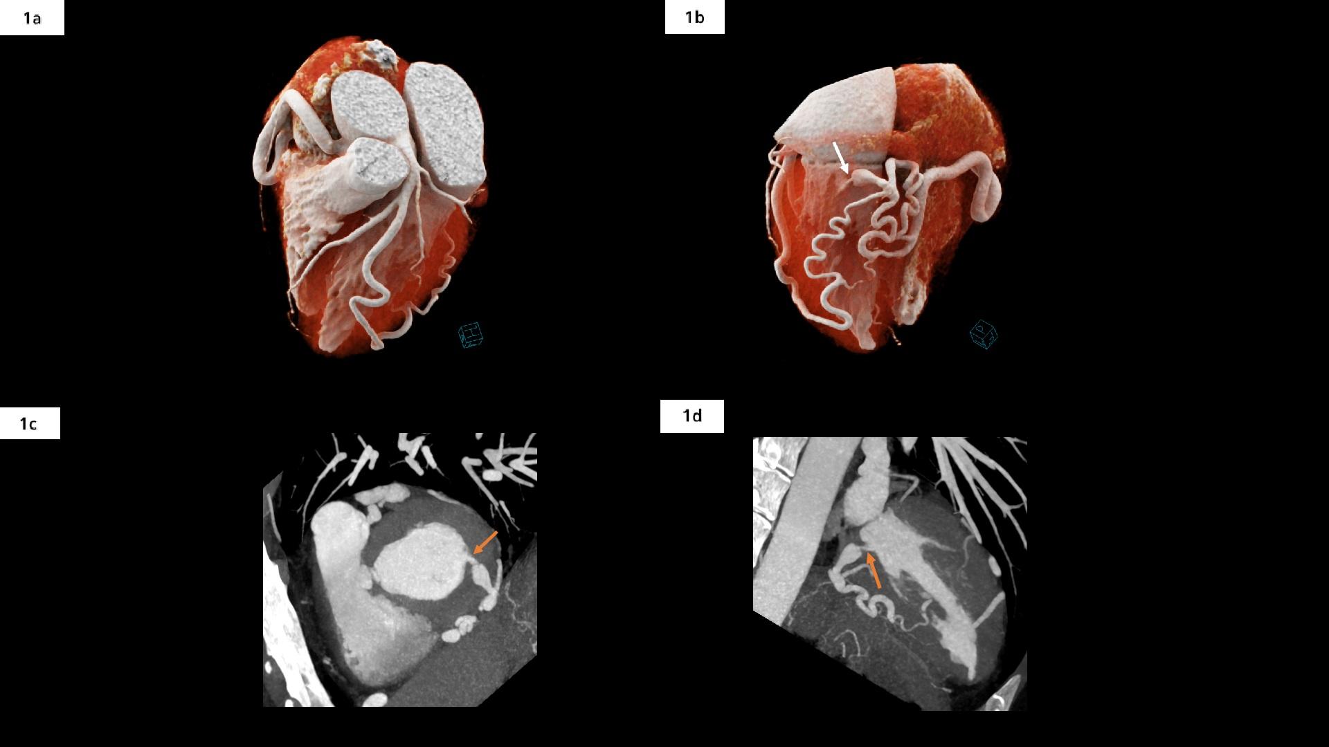 Coronary Cameral Fistula - Siemens Healthineers USA