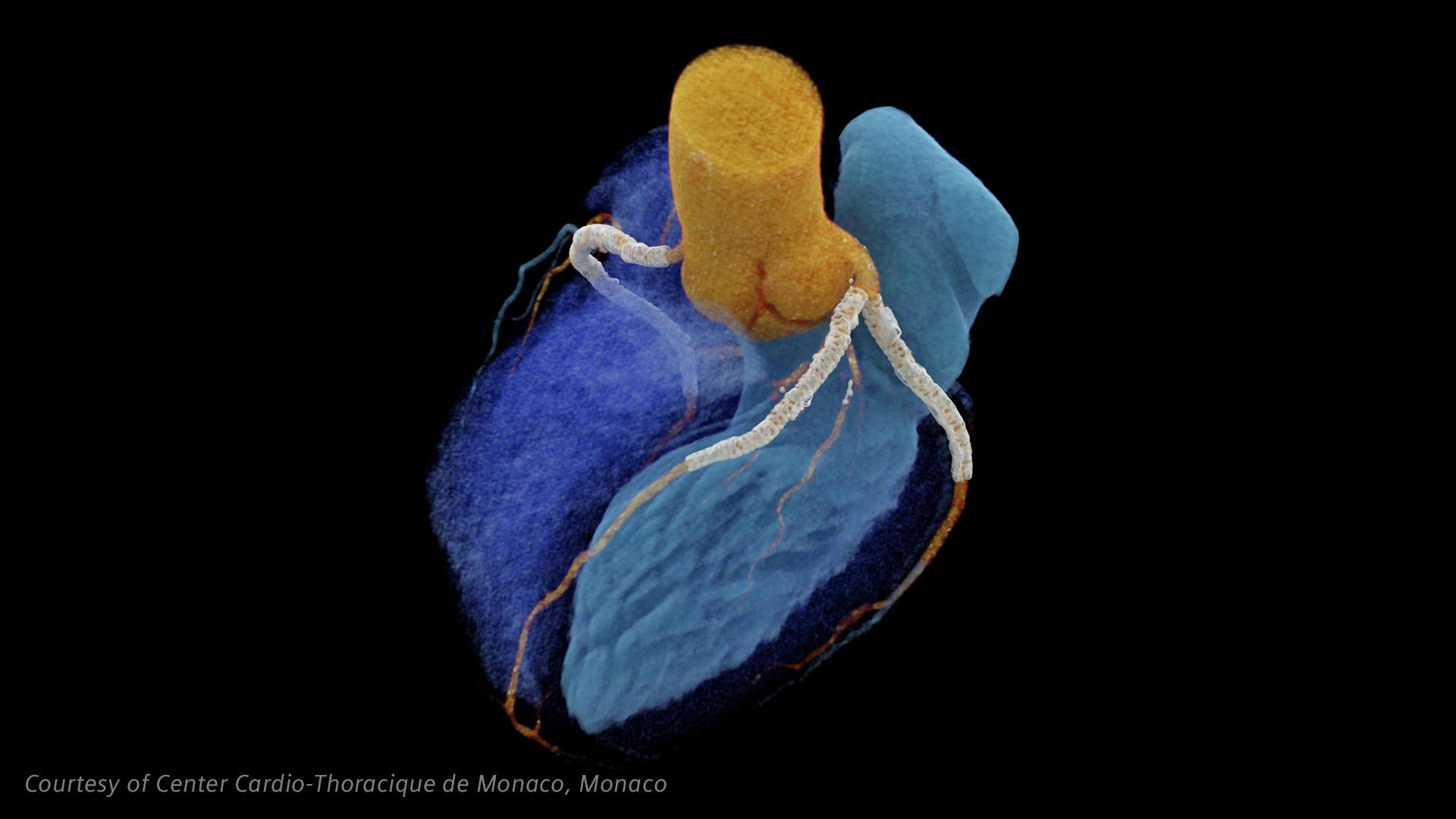 NAEOTOM Alpha.Peak - Siemens Healthineers Bulgaria