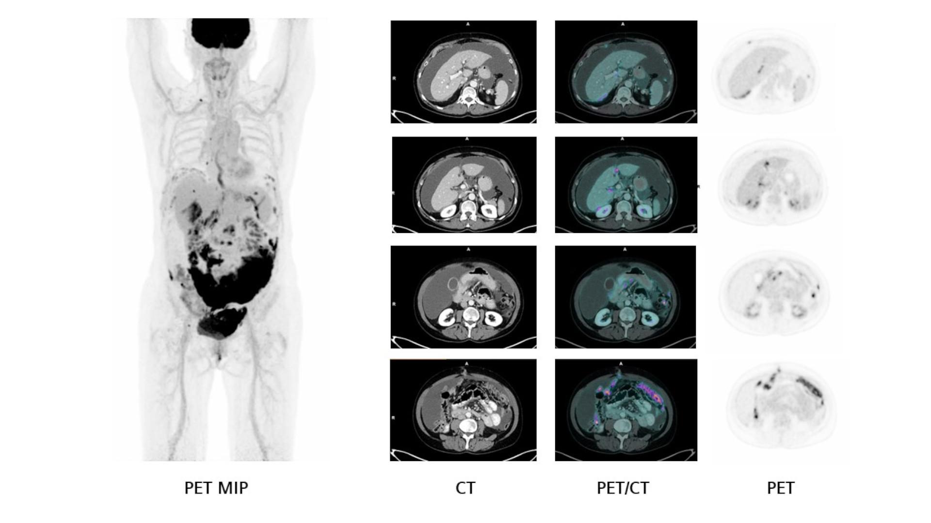 18F-FDG delineation of peritoneal carcinomatosis in ovarian carcinoma