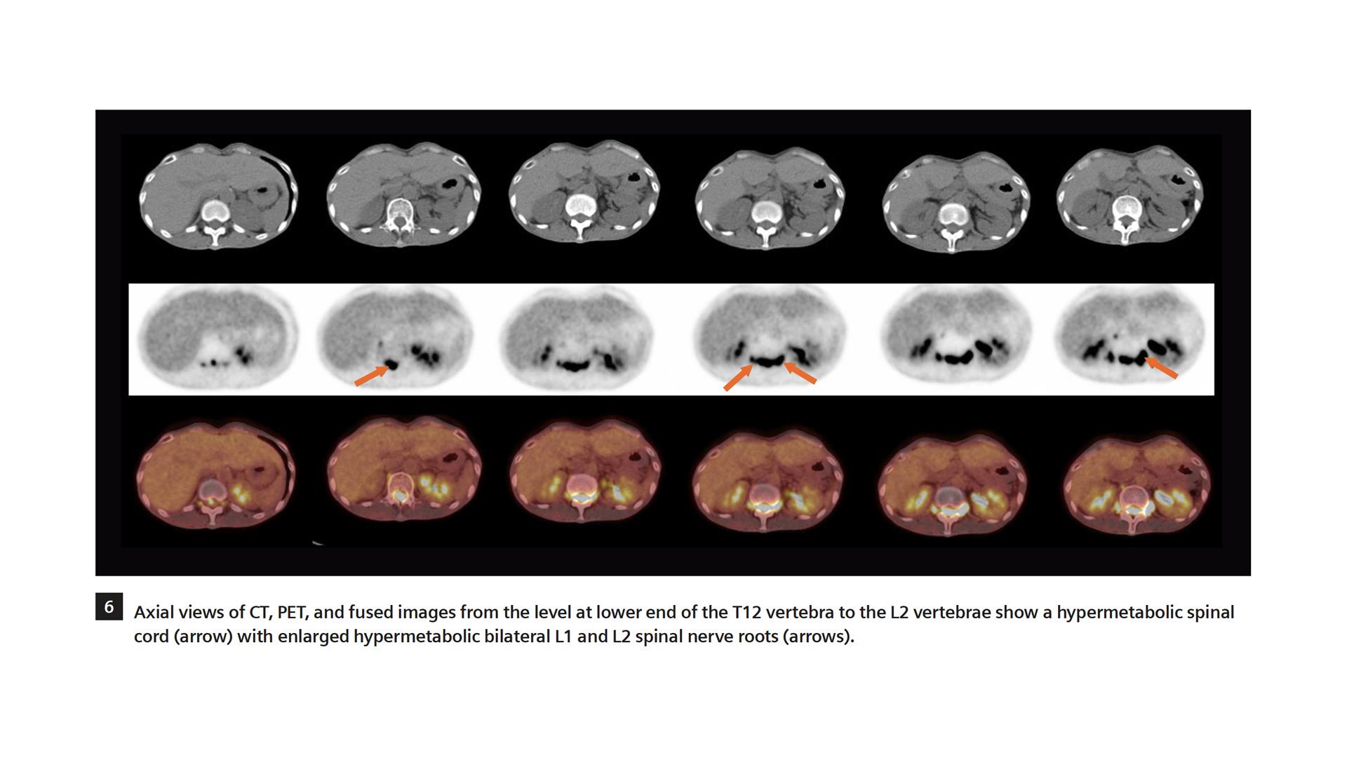 18F FDG PET/CT delineation of diffuse large B-cell lymphoma involving ...