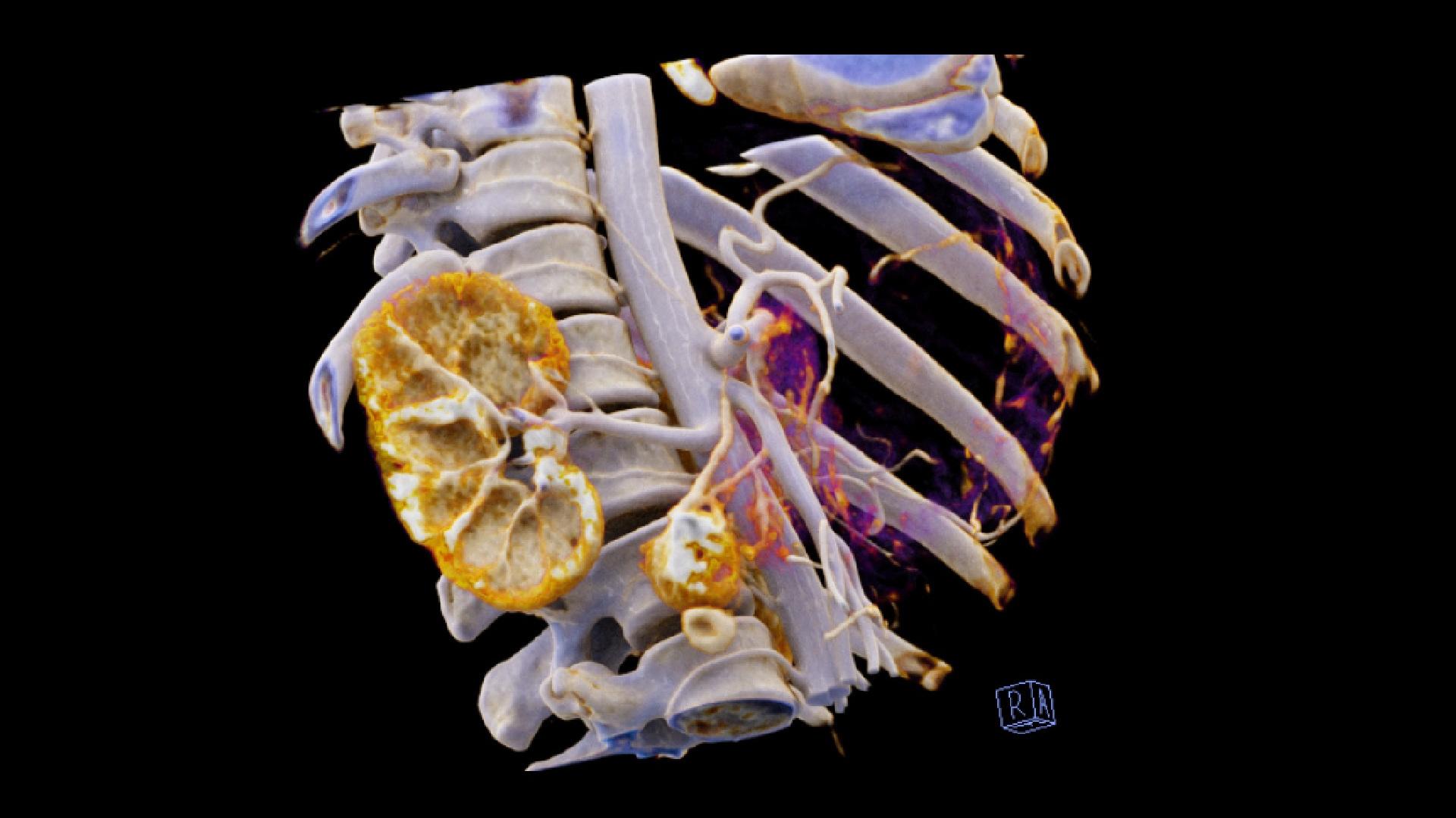 Multiple gastrinomas - Siemens Healthineers USA
