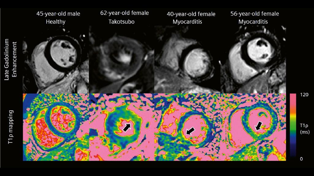 Cardiac Magnetic Resonance T1-rho Mapping at 1.5T