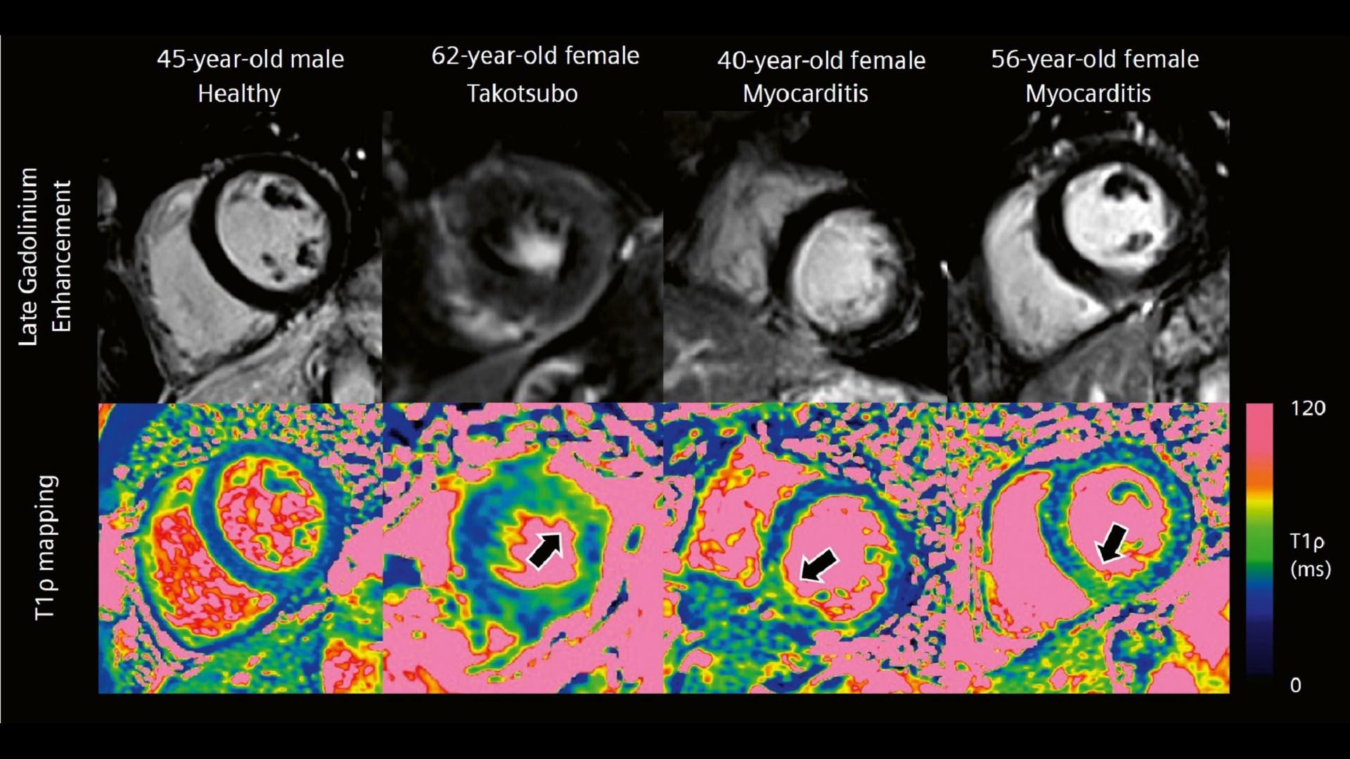 Cardiac Magnetic Resonance T1-rho Mapping at 1.5T