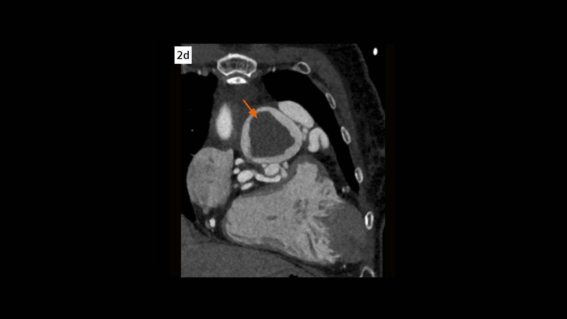 Complex Coronary Artery Fistula - Siemens Healthineers USA