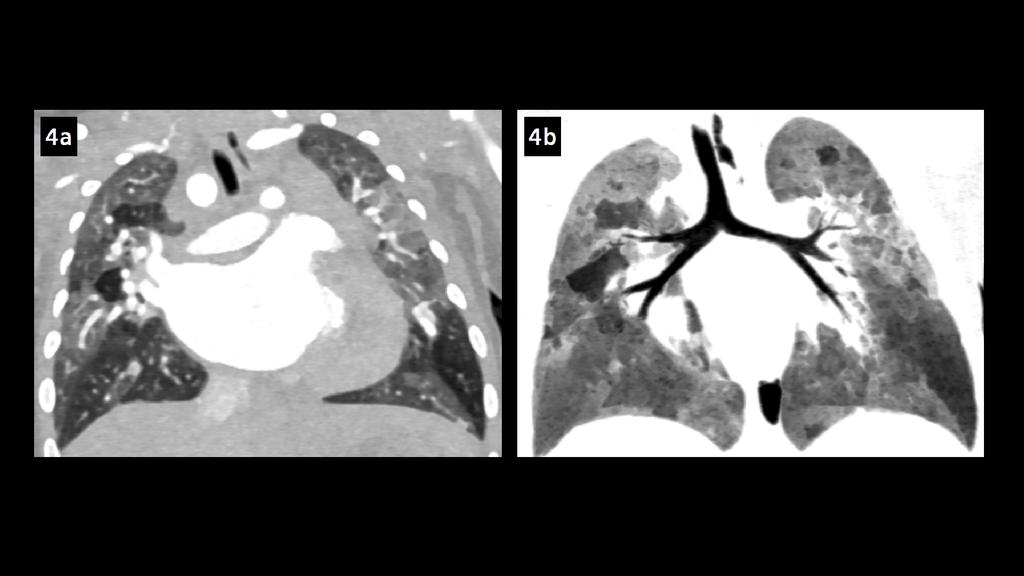 Preoperative evaluation in a case of Tetralogy of Fallot - Siemens ...