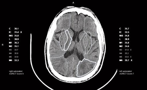 Stroke Imaging