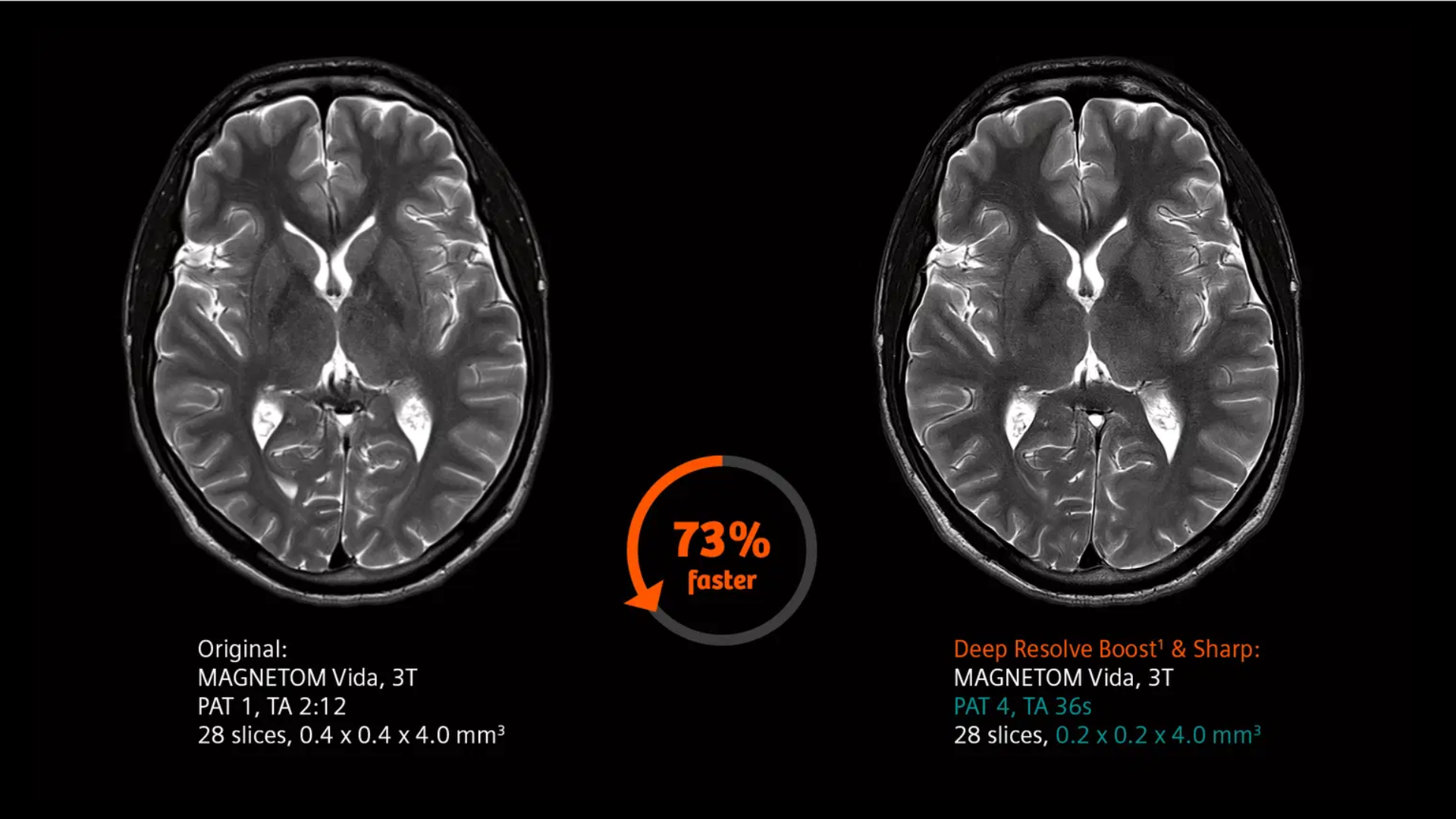 MRI for Alzheimer's disease - Siemens Healthineers USA