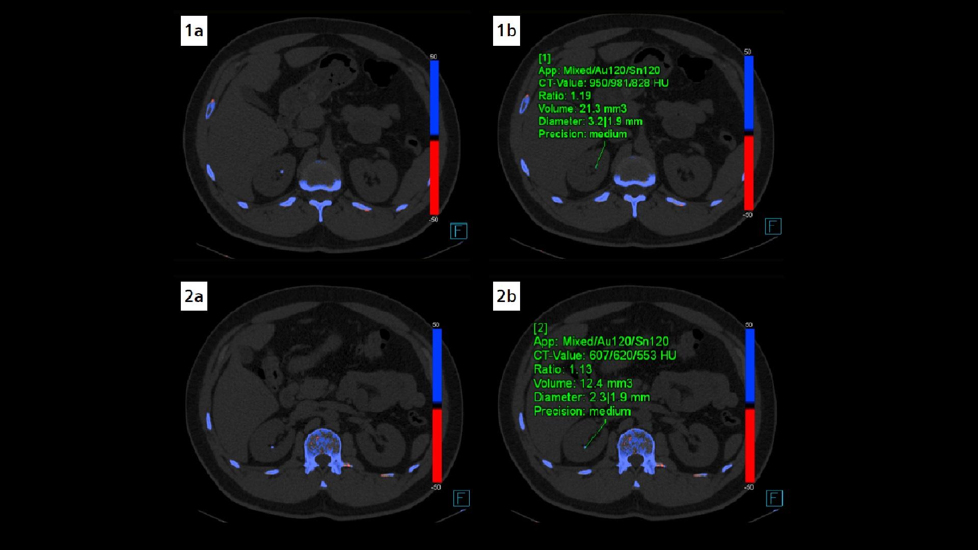 Small-sized renal calculi – uric acid or non-uric acid? - Siemens ...