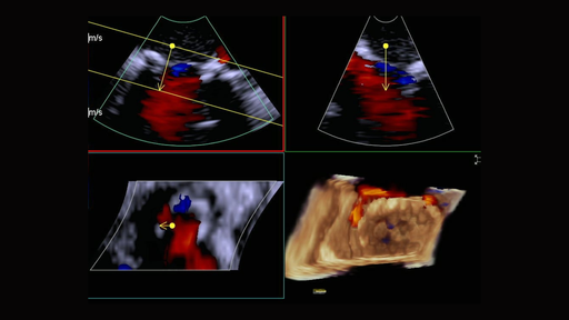 ACUSON AcuNav Volume 4D ICE Catheter - Siemens Healthineers USA