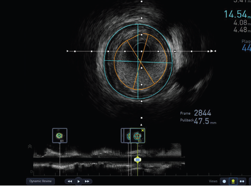 AVVIGO™+ Guidance System - Siemens Healthineers USA