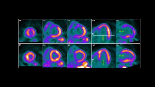 Expanding access to advanced cardiac care: The rise of PET/CT imaging