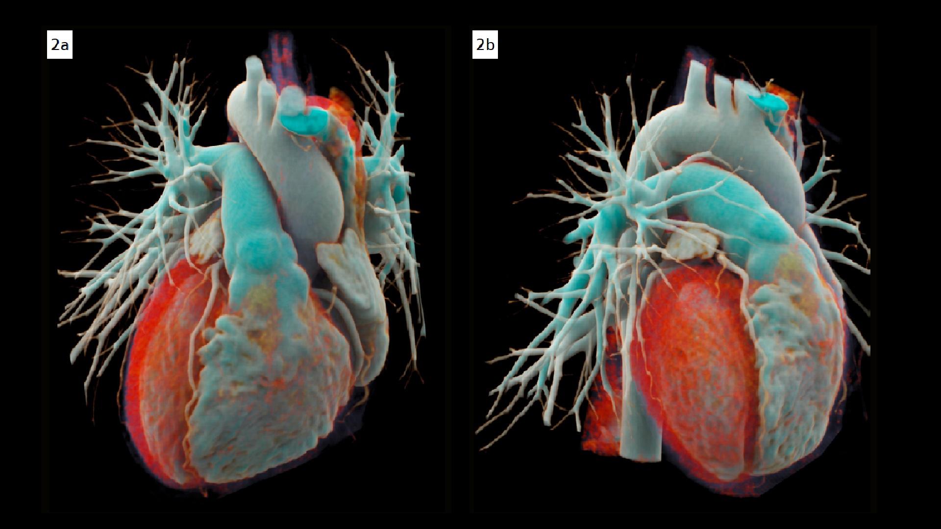 Situs inversus totalis discovered incidentally in an adult - Siemens ...