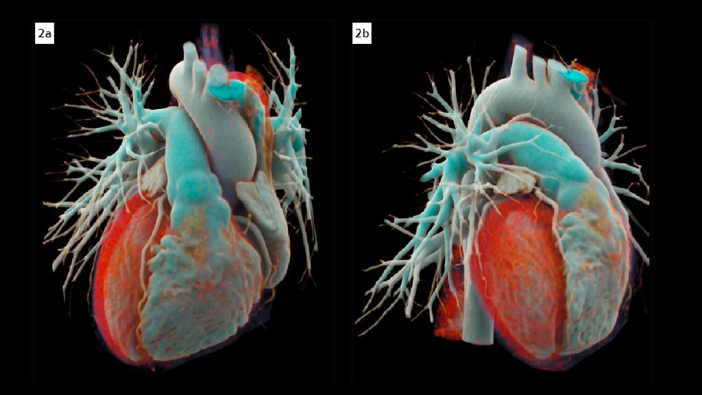 Situs inversus totalis discovered incidentally in an adult - Siemens ...