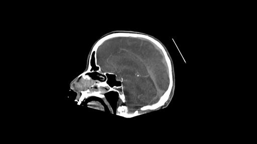 Advanced stroke management and patient care - Siemens Healthineers