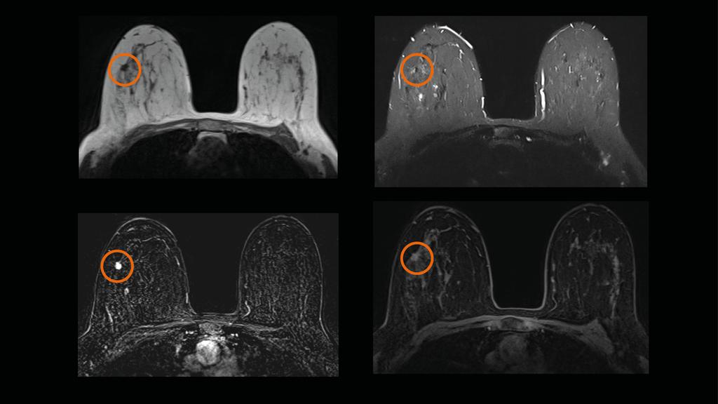 Identificación de Carcinoma lobular invasivo grado 3 por tomosíntesis ...