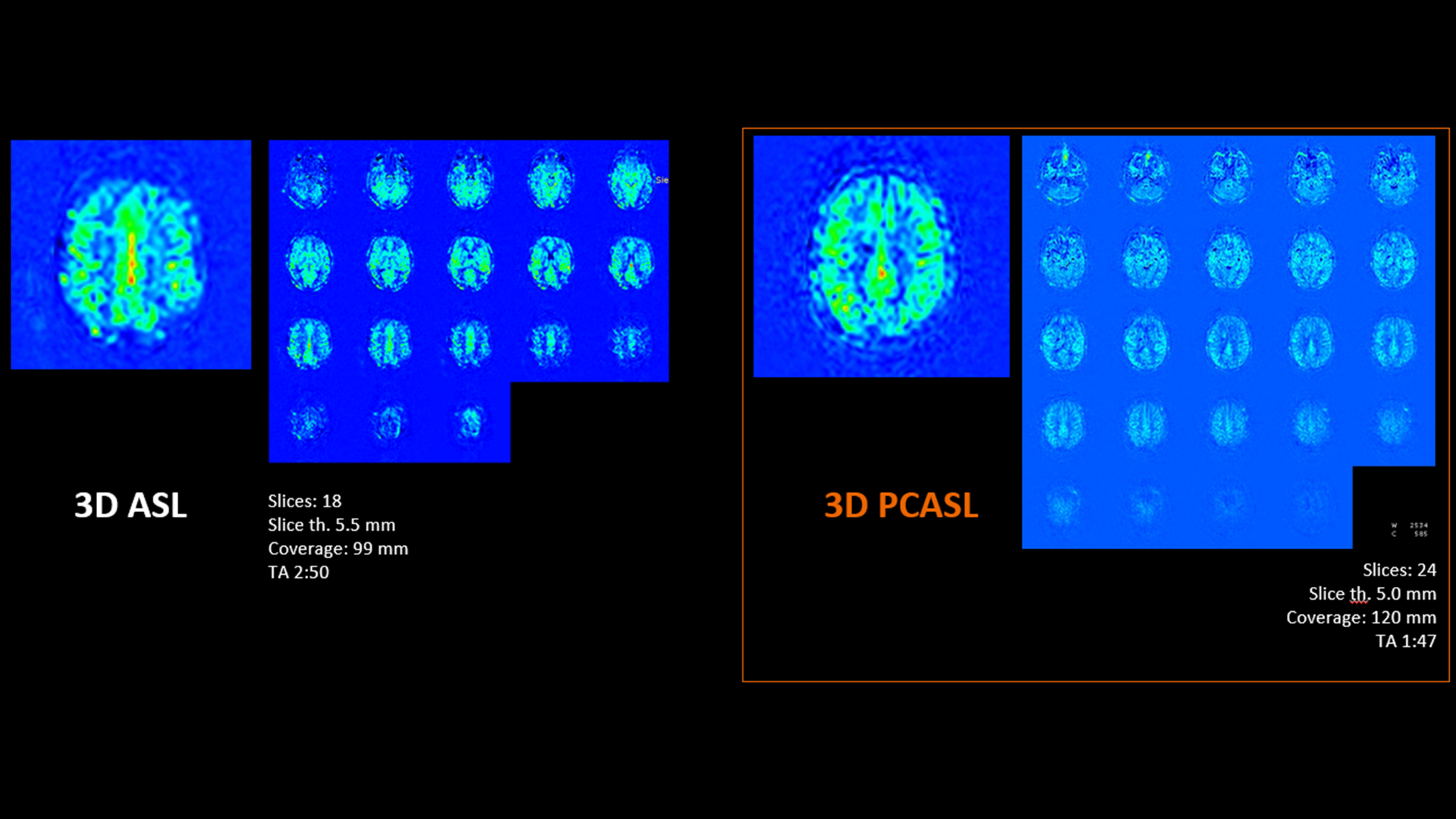 PCASL - Siemens Healthineers