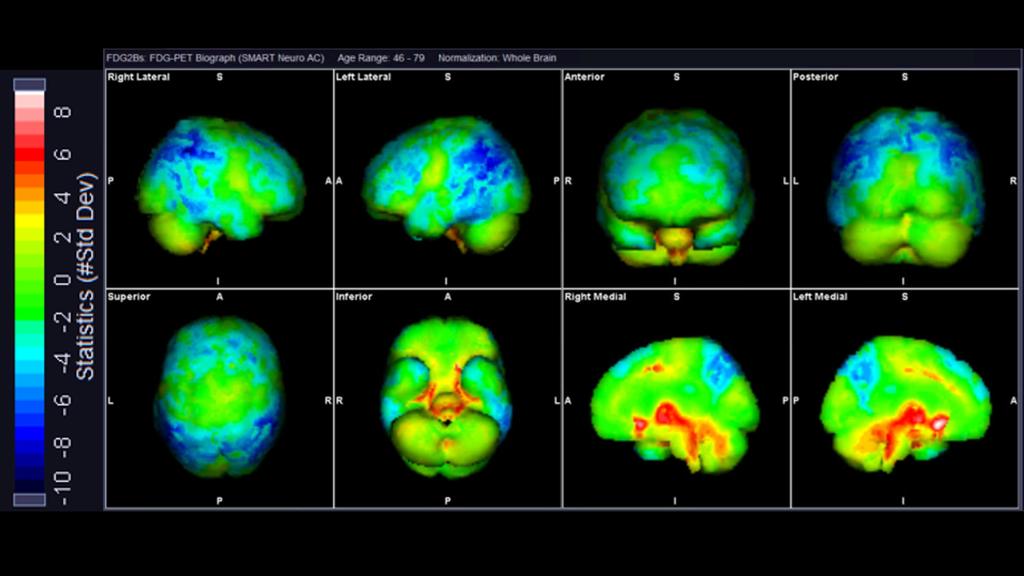 Beta-amyloid PET/CT imaging in the assessment for anti-amyloid monoclonal therapy - Siemens ...