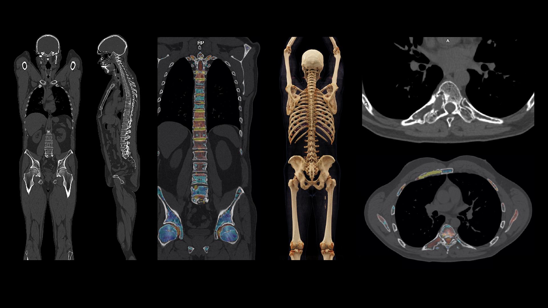 PCCT oncology imaging - Siemens Healthineers