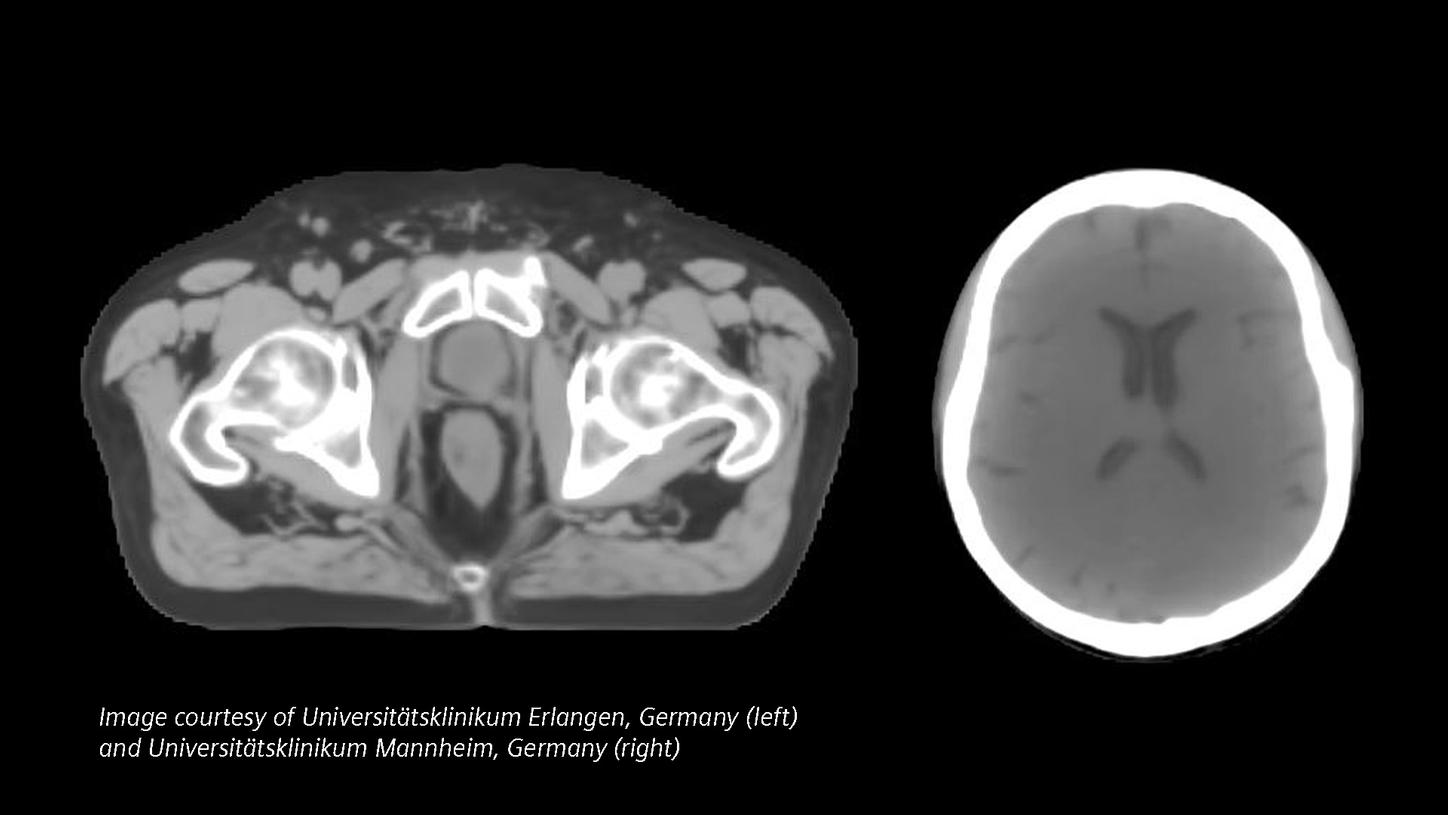 MR-only radiotherapy planning with Synthetic CT - Siemens Healthineers