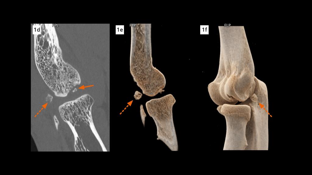 Osteochondritis dissecans of the capitellum - Siemens Healthineers