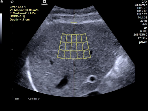 ACUSON Sequoia Ultrasound System - Siemens Healthineers USA