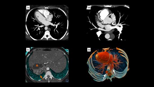Situs inversus totalis discovered incidentally in an adult Siemens ...