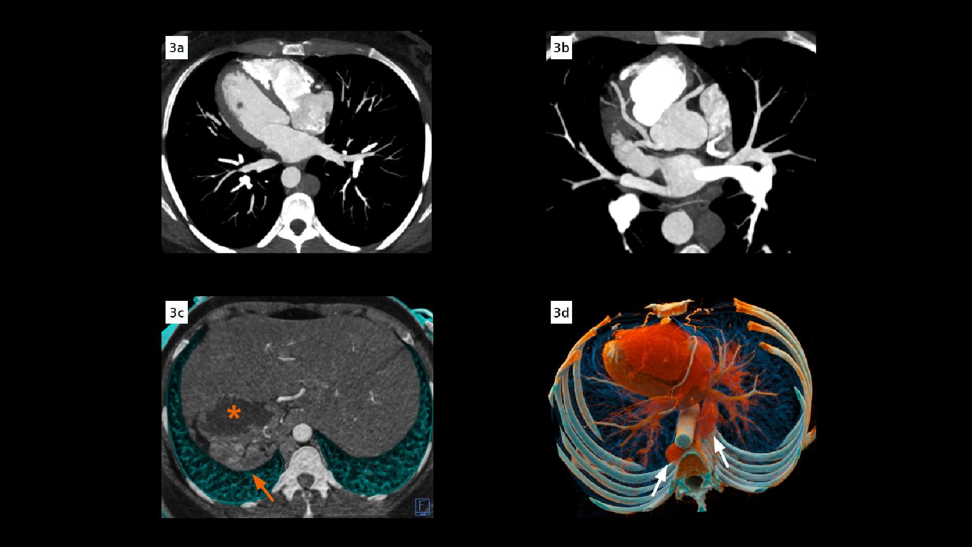 Situs inversus totalis discovered incidentally in an adult - Siemens ...