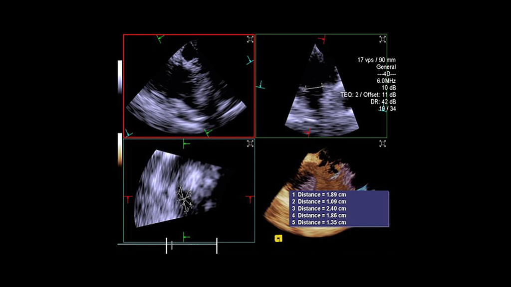 LAAC - Siemens Healthineers USA