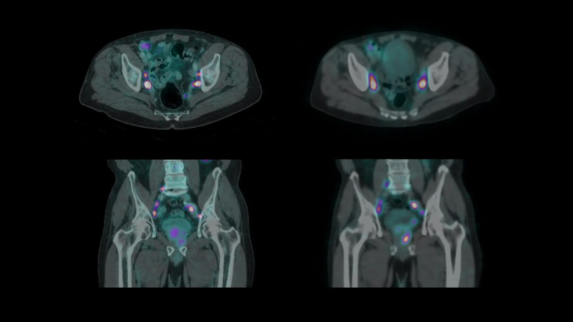 A comparative analysis of 99mTc-iPSMA SPECT/CT and 18F-PSMA-1007 PET/CT