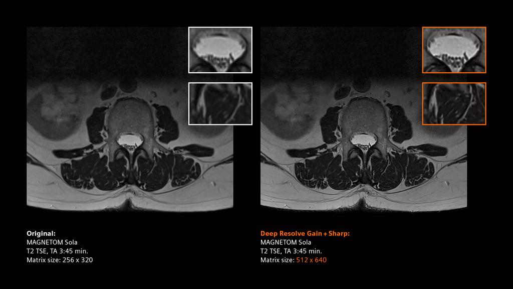 Deep Resolve - Siemens Healthineers France