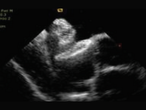 Intracardiac Echocardiography with AcuNav Ultrasound Catheters ...