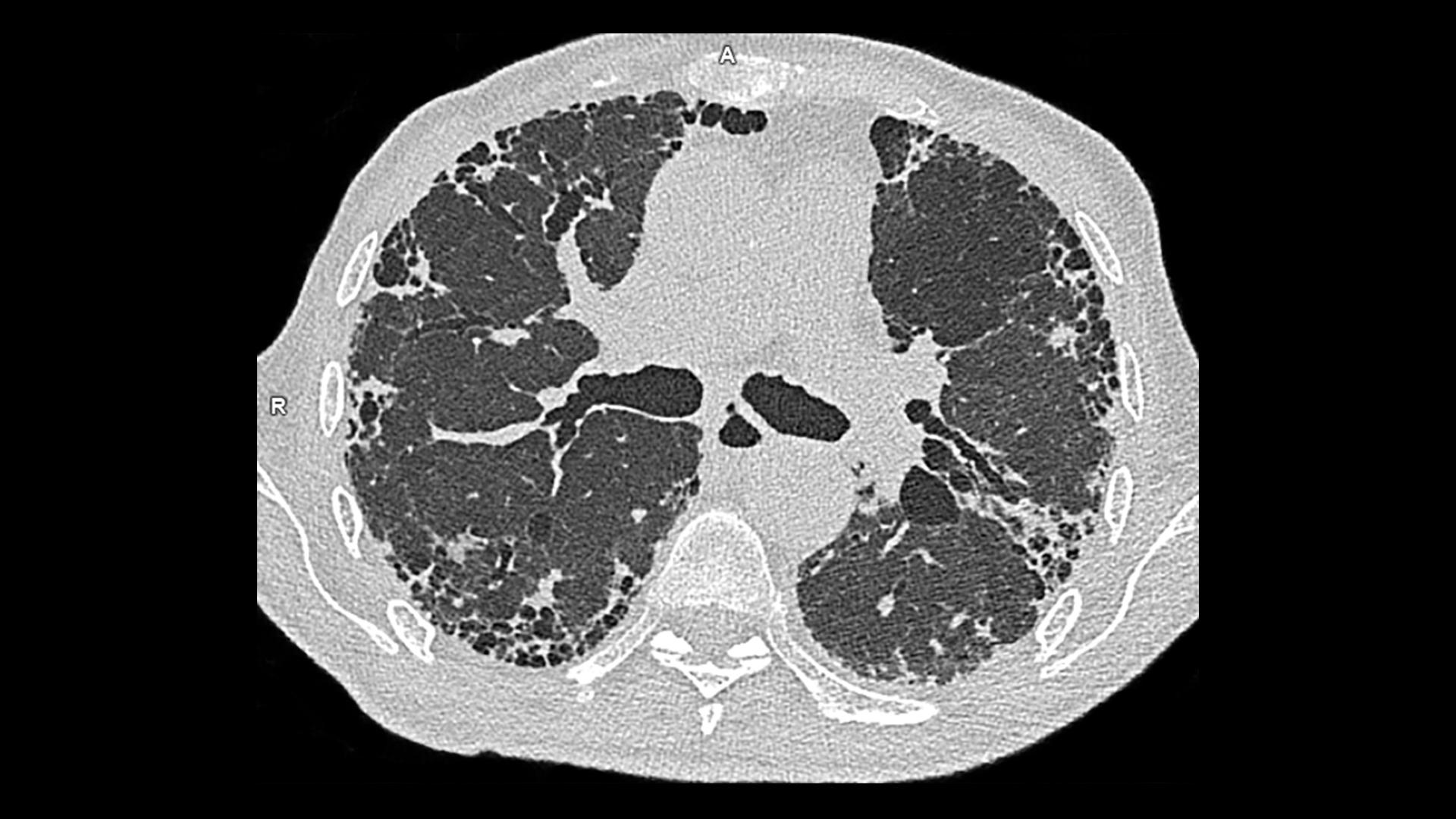 PCCT pulmonology imaging - Siemens Healthineers