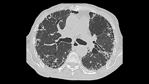 PCCT pulmonology imaging - Siemens Healthineers
