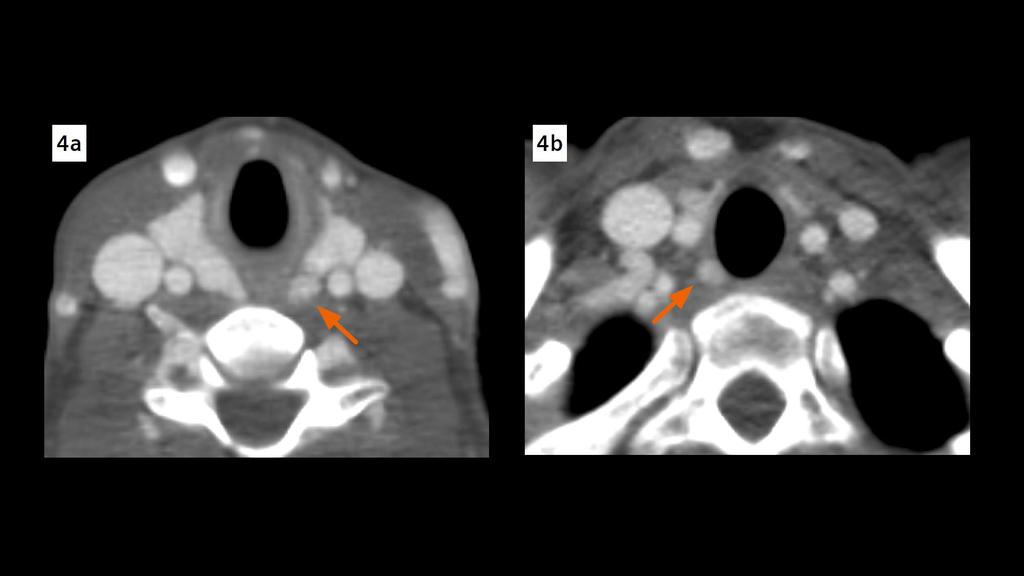 Multiple gastrinomas - Siemens Healthineers USA