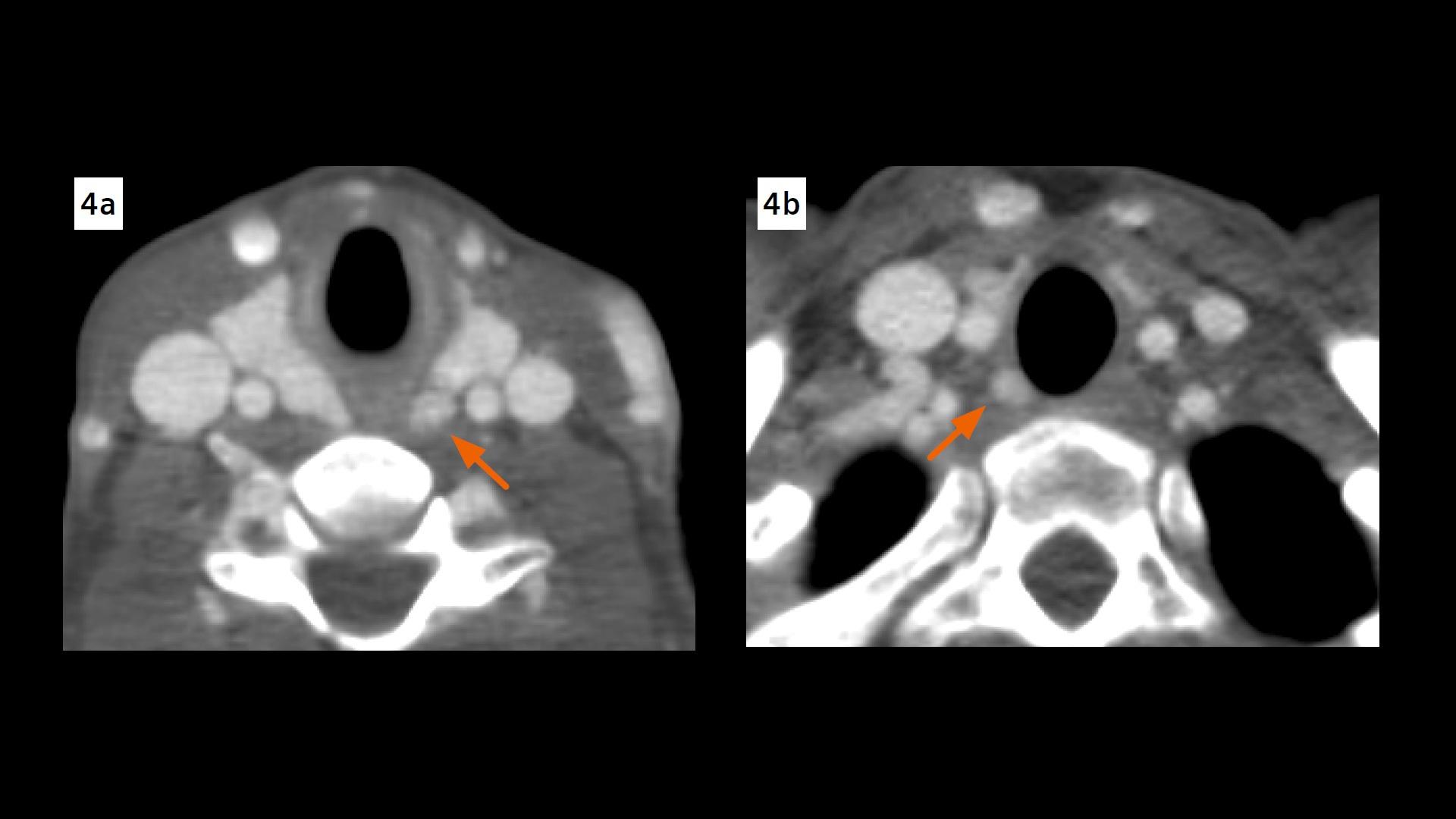 Multiple gastrinomas - Siemens Healthineers USA