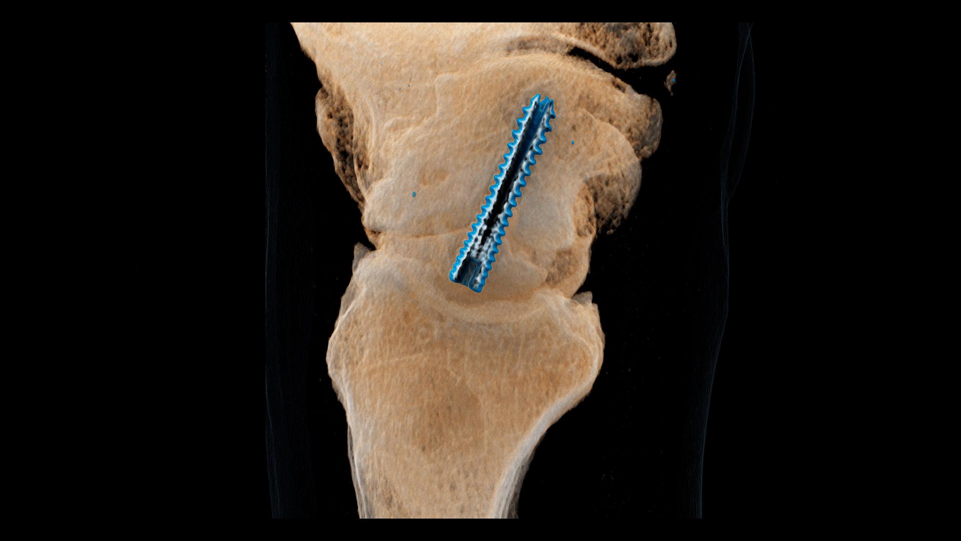 Photon-counting CT musculoskeletal imaging - Siemens Healthineers
