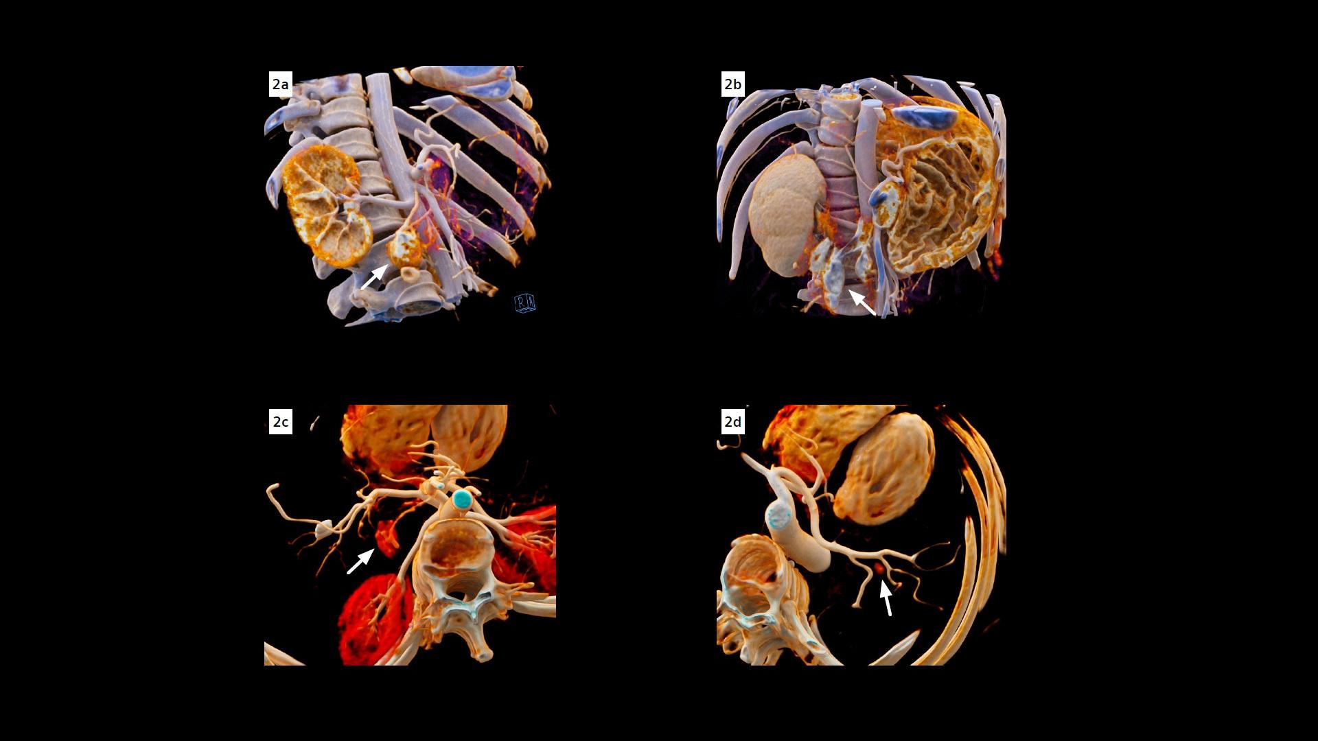 Multiple gastrinomas - Siemens Healthineers