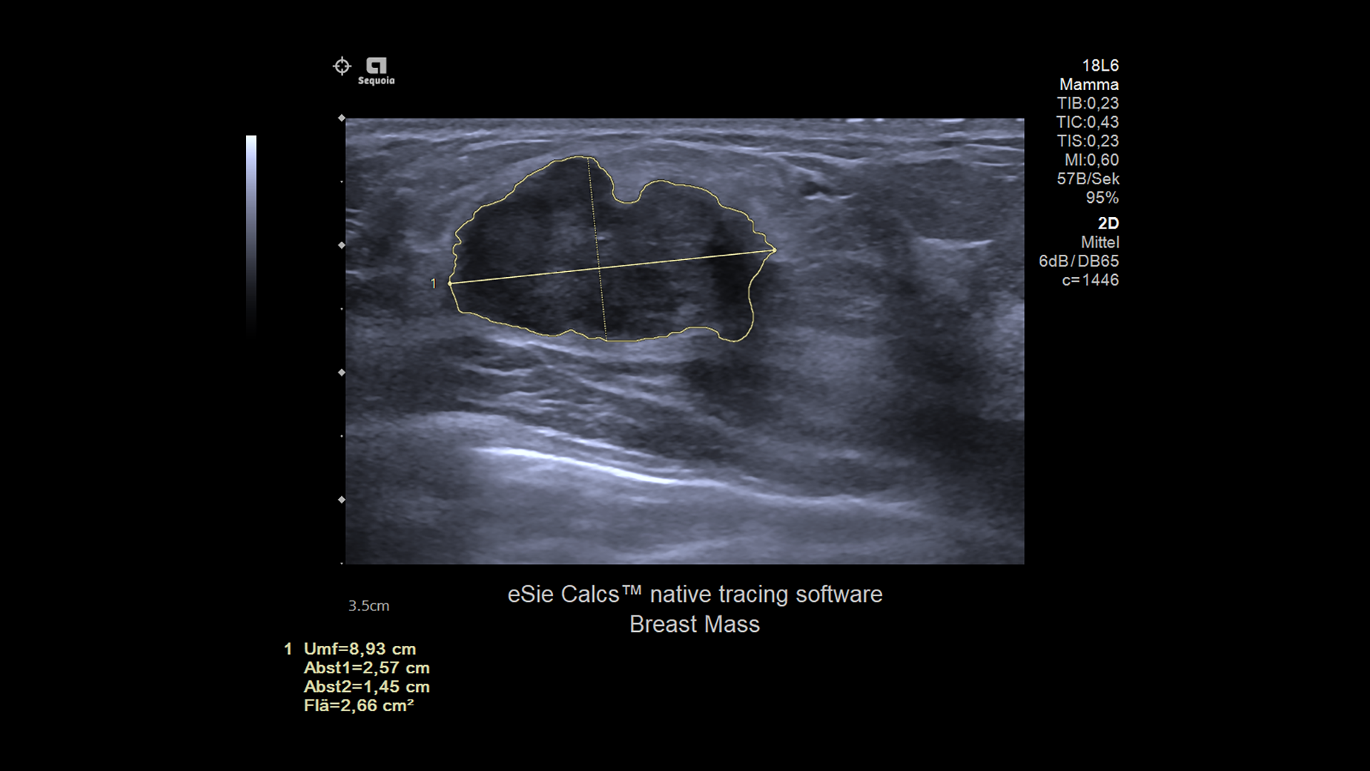 ACUSON Sequoia Ultrasound System - Siemens Healthineers