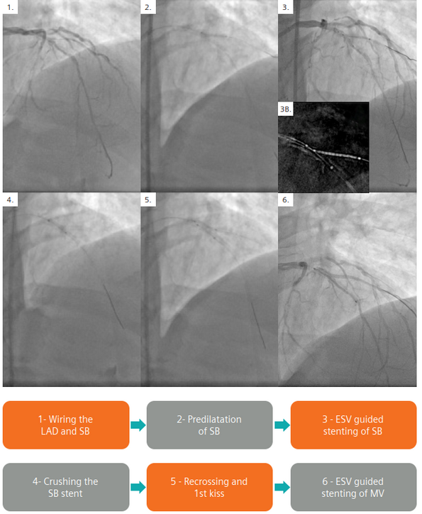 Advancing Coronary Bifurcation Stenting and Calcified Lesion Management