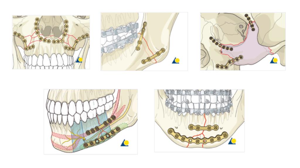 Fractura conminuta panfacial compleja - Siemens Healthineers Latinoamérica