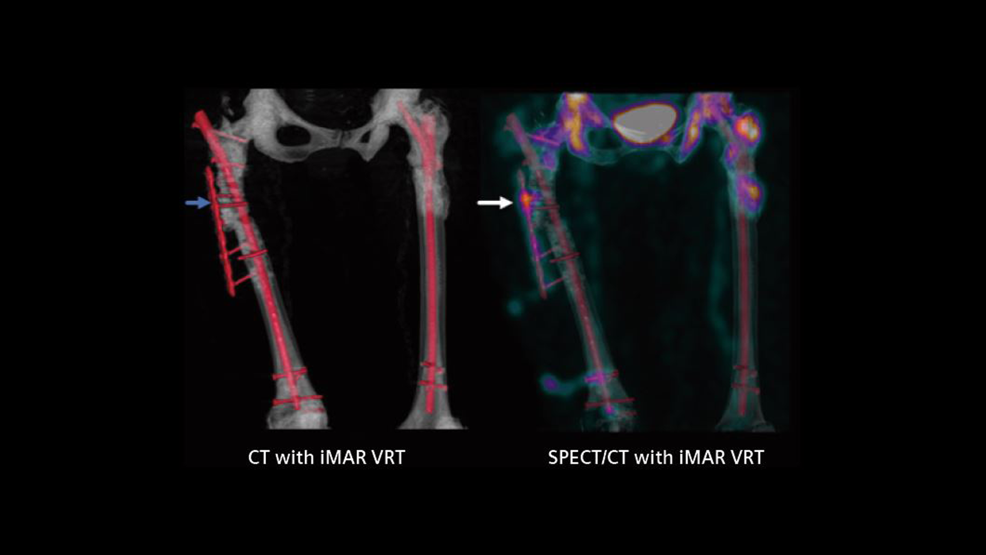 Localization Of Infection Site In Femoral Stabilization Pin - Siemens ...