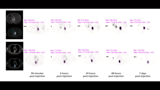 Tumor and organ dosimetry from sequential quantitative SPECT/CT - Siemens Healthineers Romania