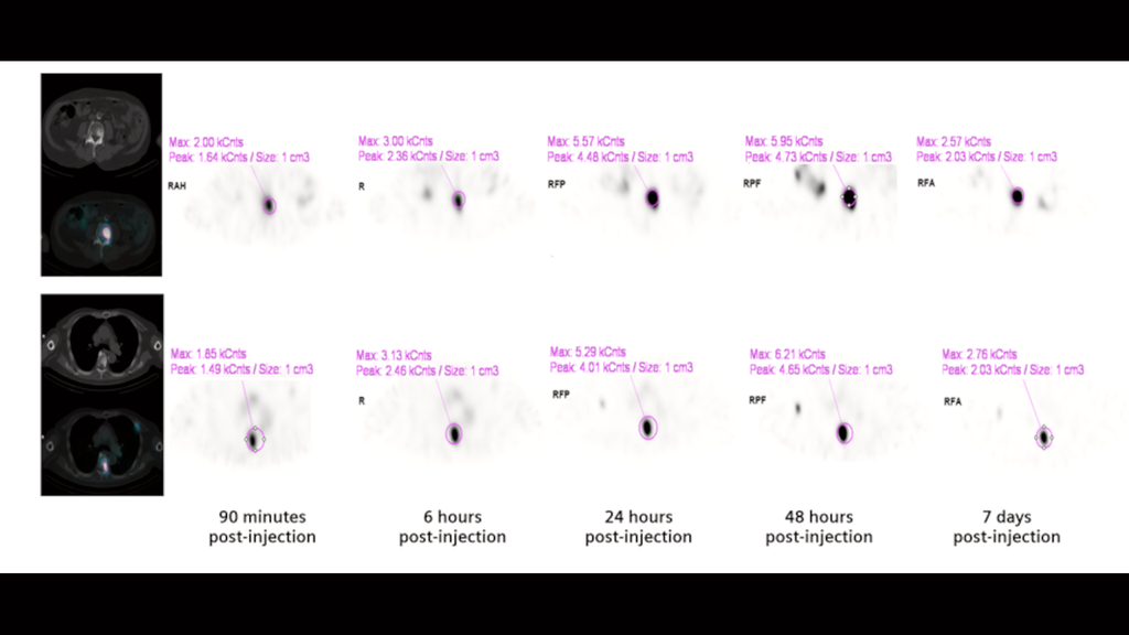 Tumor and organ dosimetry from sequential quantitative SPECT/CT ...