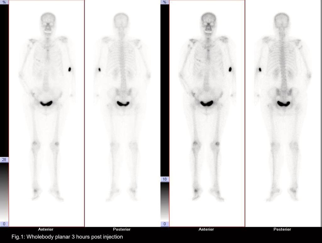 How SPECT-CT helps to clarify severe pain, 1 year after shoulder ...