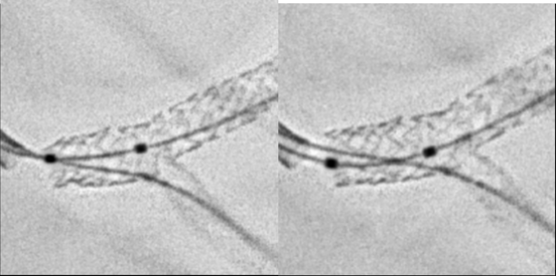 Enhanced stent visualization assists in improving the outcome of ...