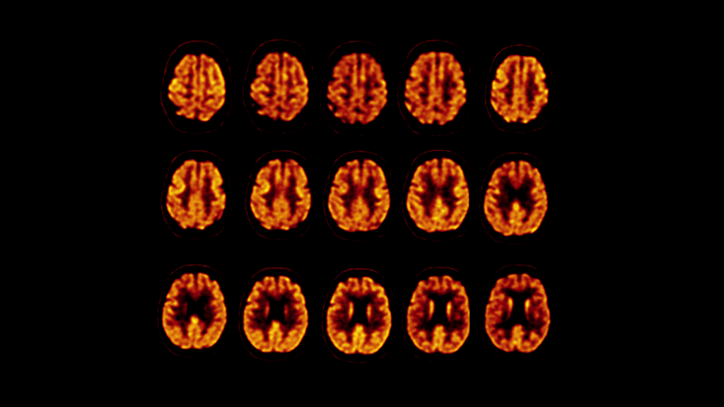 Biograph Horizon PET/CT scanner - Siemens Healthineers
