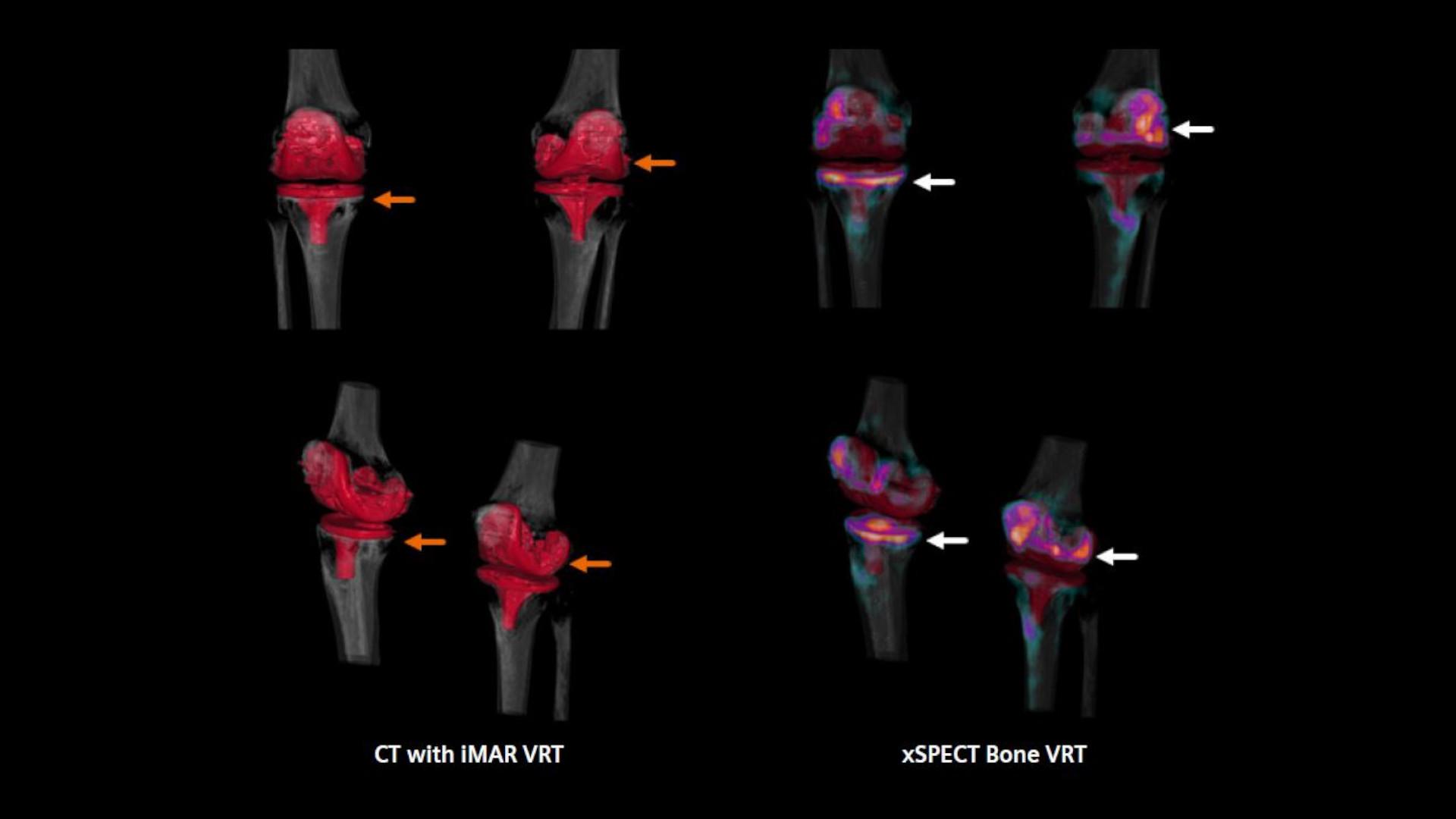 Spect Ct Detection In Tka Prosthetic Loosening Siemens Healthineers