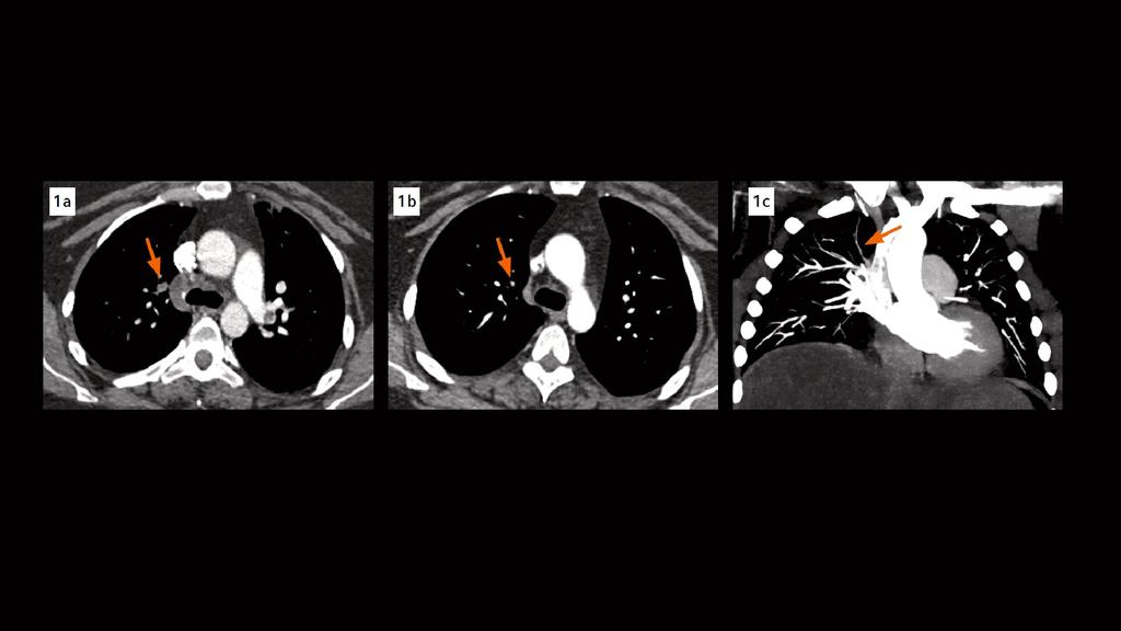 Follow-up of an acute pulmonary embolism in an obese patient with an ...