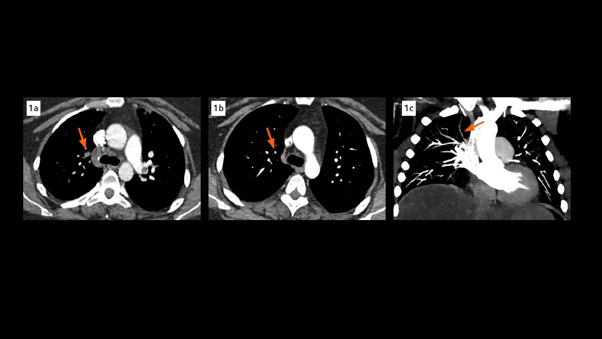Follow-up of an acute pulmonary embolism in an obese patient with an ...